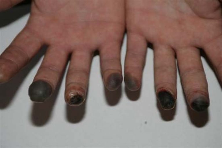 Survival Skills: How to Treat Frostbite - TheGearHunt